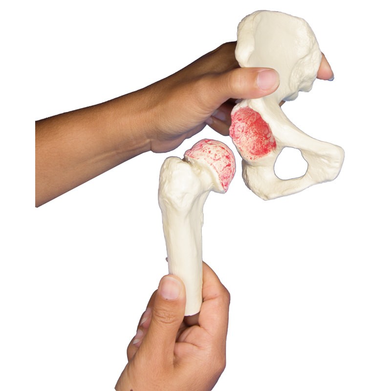 Hip Implant Model | Health and Care
